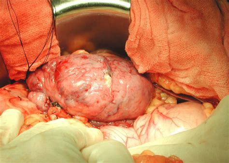 Intra Operative View Of The Duodenal Gist Download Scientific Diagram