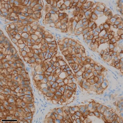 Breast Cancer Her2 Staining 20x Galleries Nikon Europe Bv