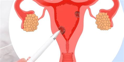 Penyebab Kanker Rahim Yang Perlu Diperhatikan Oleh Wanita