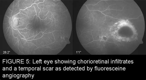 Left Eye Showing Chorioretinal Infiltrates And A Temporal Scar As