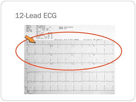 Ppt The 12 Lead Ecg In Acute Coronary Syndromes Powerpoint