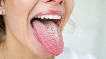 Tongue With White Coating Oral Thrush Or Candidiasis Stock Illustration Illustration Of