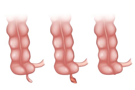 7 Caecal Appendix Royalty Free Photos And Stock Images Shutterstock