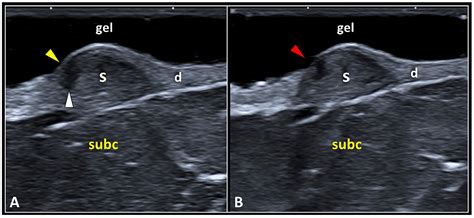 From Histopathology To High Resolution Ultrasound Imaging Of Skin Scars