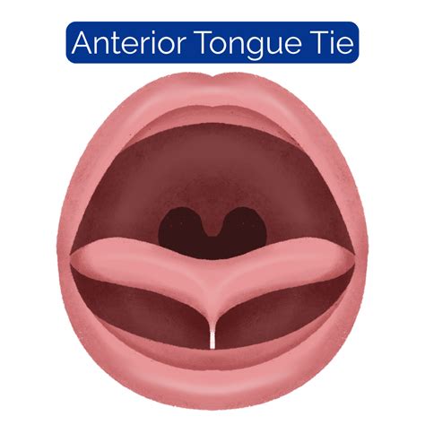 Types Of Tongue Tie In Babies