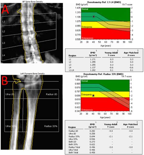 Bone Density Scan Measurements At Karen Acuff Blog