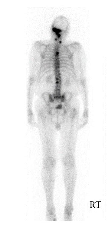 Nuclear Medicine Bone Scan Using Technetium 99m MDP Posterior View Download Scientific