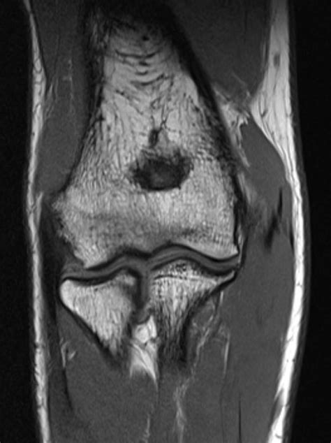 МРТ Локтевой сустав