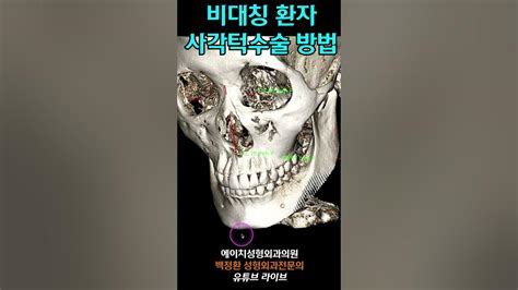비대칭 환자 턱 수술 방법 Shorts Youtube