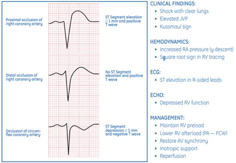 Right Ventricular Involvement Ecg Clinical View