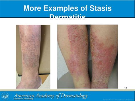 Stasis Dermatitis Causes