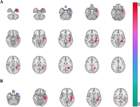 Voxel Wise P Map For Predictions Of Verbal Memory Scores Note This