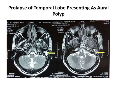 Prolapse Of Temporal Lobe Presenting As Ear Polyp Ppt