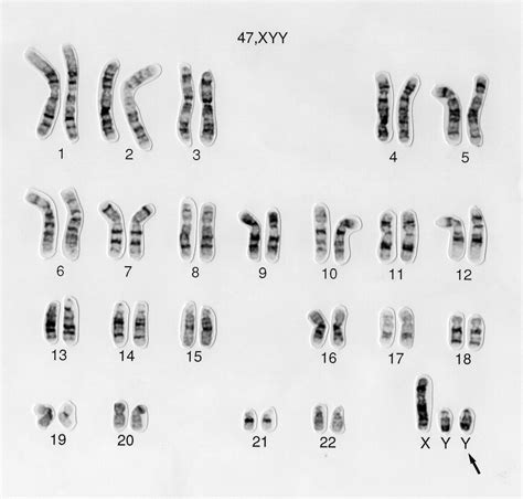 Xyy Karyotype