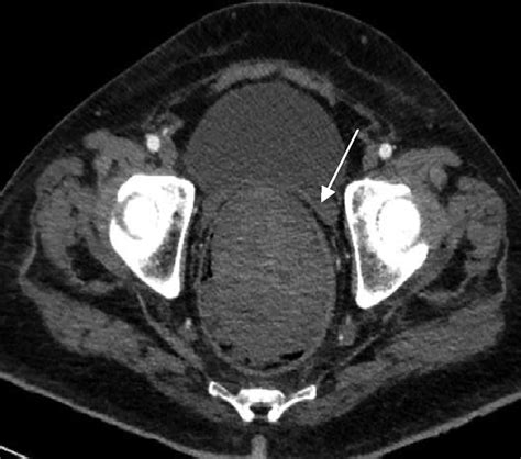 Axial Image Of Abdominal Ct With Contrast That Shows A Solid Download Scientific Diagram