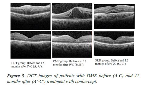 Conbercept In Treating Diabetic Macular Biomedical Research