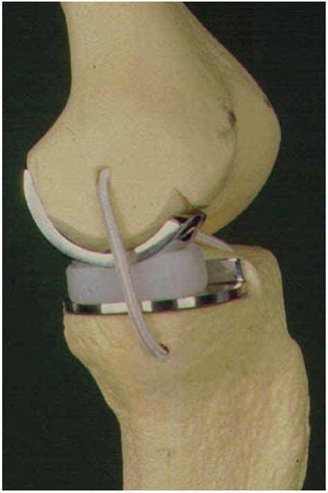 Is Patella Facet Arthritis A Contraindication To Unicompartmental Knee Arthroplasty Current