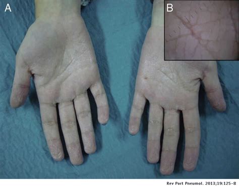 Aquagenic Keratoderma Associated With A Mutation Of The Cystic Fibrosis Gene Pulmonology