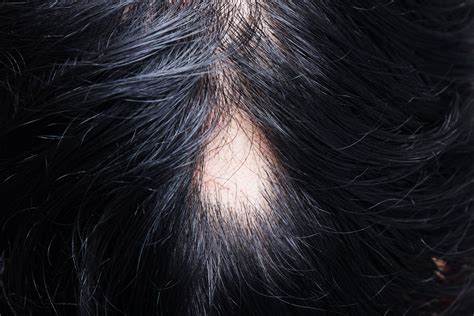 This Follicle Hacking Drug Could One Day Treat Baldness Wired