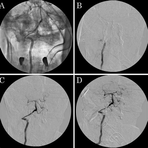 On Selective Arteriography The Left Vertebral Artery Is Contrasted In Download Scientific