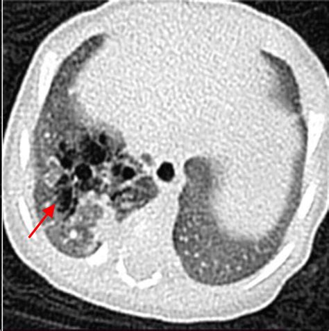Axial Hrct Image Shows Air Filled Cystic Lesion With Multiple