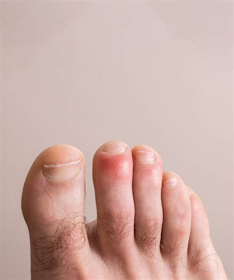 Chilblains Zerosole