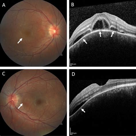 Right A And Left C Eyes Retinography Depicting Hyperemic Optic
