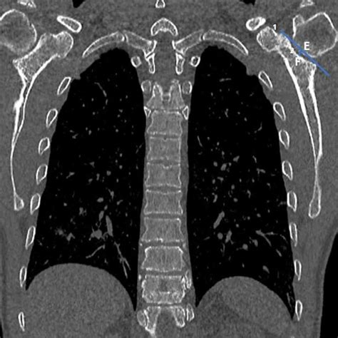 Demonstration Of Measurement Of The Depth Of Glenoid Cavity At The