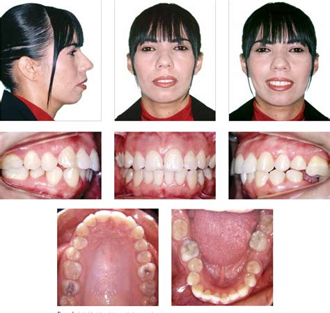 Maxillary Protrusion