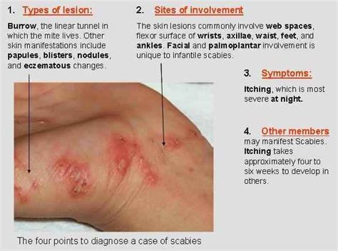 Scabies Bite Marks