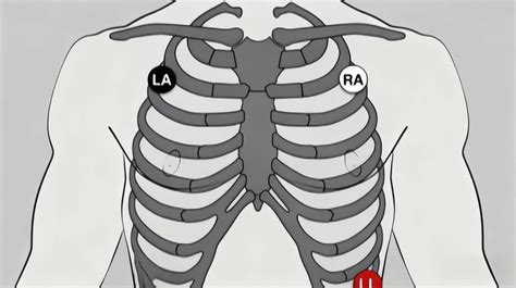 3 Lead Ecg Placement Correct Positions With Color Diagram