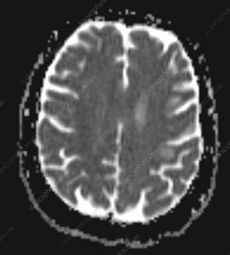 Subacute Infarct Mri Stock Image C0393581 Science Photo Library