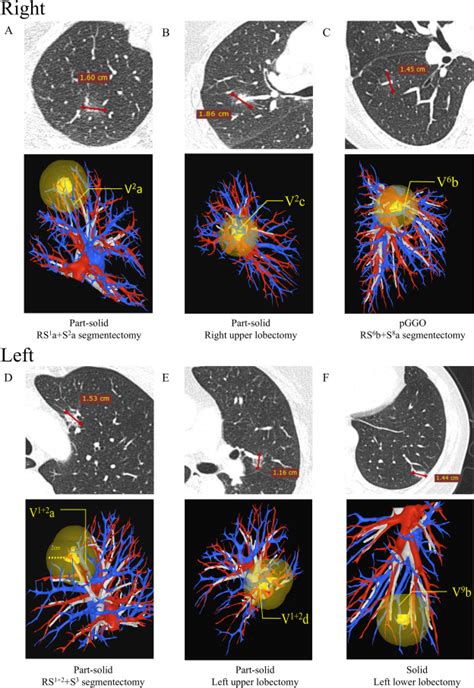 Segmentectomy Versus Lobectomy For Intersegmental Small Sized Non Small Cell Lung Cancer