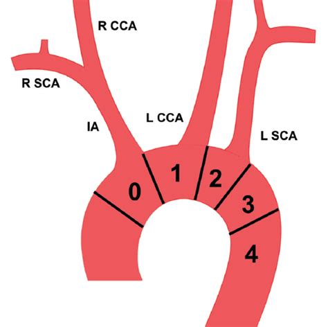 Carotid Subclavian Transposition