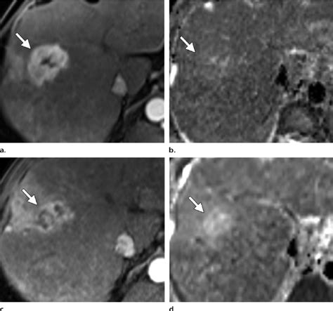 Hepatocellular Carcinoma Treated With 90 Y Radioembolization In A Download Scientific Diagram