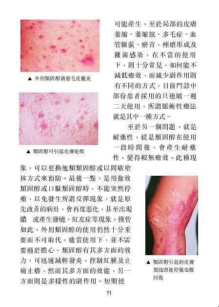 Psoriasis Book