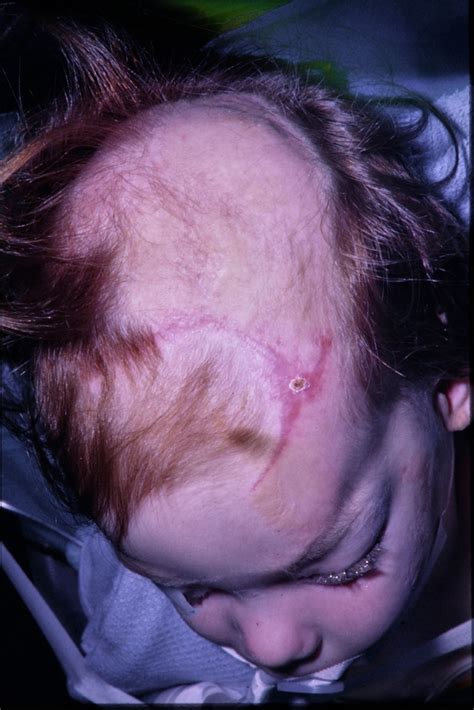 Linear Nevus Sebaceous Syndrome Retina Image Bank