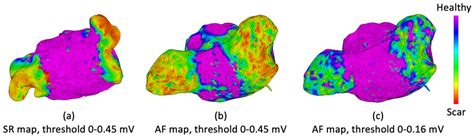 Example Of Need For A Threshold To Be Used On Voltage Maps Obtained