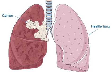 Lungs PMG Biology