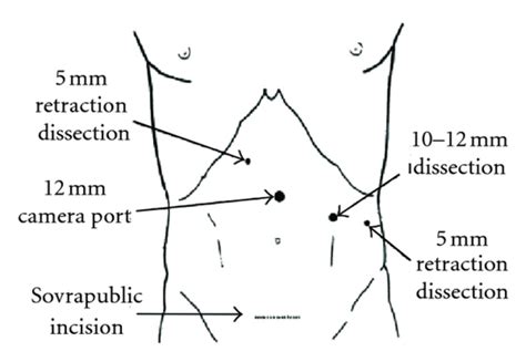 Disposition Of Trocars For Laparoscopic Splenectomy Download Scientific Diagram
