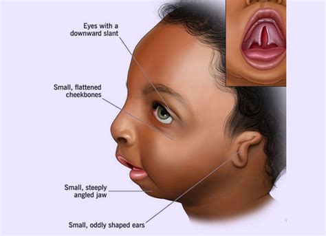 Treacher Collins Syndrome Focus Dentistry