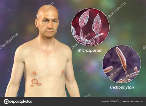 Infeksi Jamur Pada Tubuh Manusia Tinea Corporis Dan Close View — Foto Stok © Katerynakon 567241206