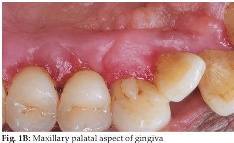 Figure 1 From Nifedipine Induced Gingival Overgrowth A Detailed Histopathological And Clinical