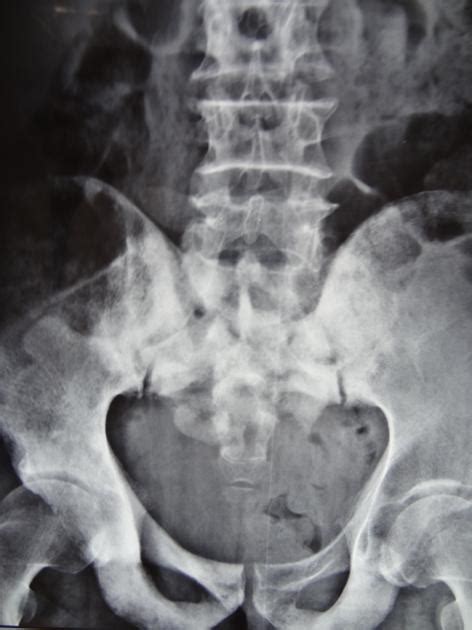 Osteoblastic Metastases Osteoblastic Response In Patients With