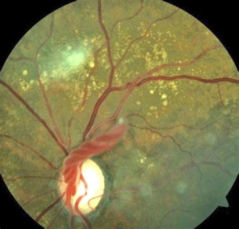 Congenital Peripapillary Vascular Loops A Rare Entity Of Vascular