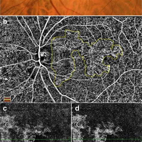 Multimodal Imaging Of Non Exudative Macular Neovascularization In The Download Scientific