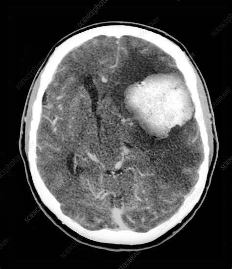 Cat Scan Brain Tumor