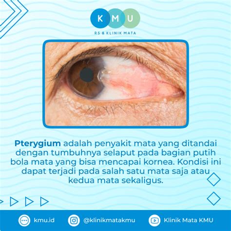 2 Cara Mengatasi Pterigium Berdasar Penyebabnya