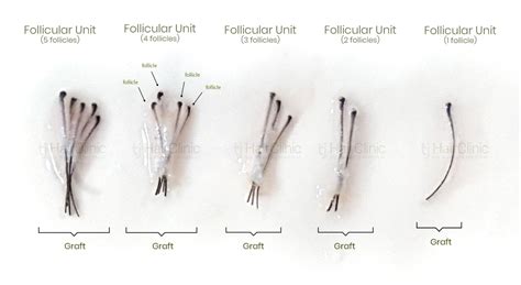 Two Hairs In One Follicle Importance In Hair Transplant Surgery