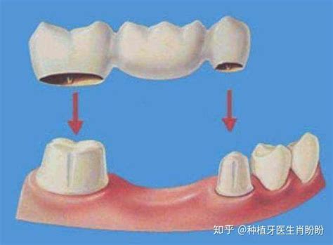 假牙 Vs 种植牙，谁更好？终于懂了 知乎